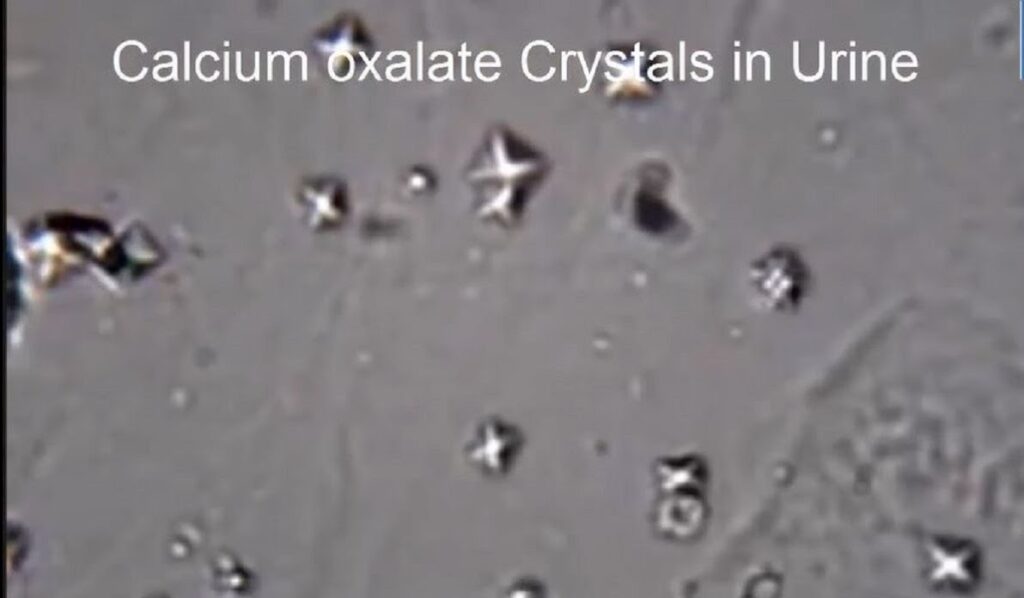 Here’s What to Do If You Find Calcium Oxalate Crystals in Urine ...